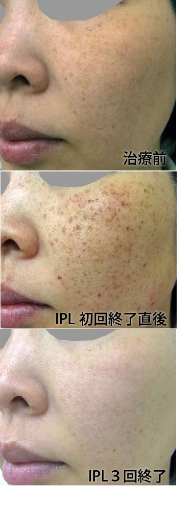 フォトフェイシャル M22 ｜新宿 高田馬場の皮膚科・美容皮膚科「山手皮フ科クリニック」